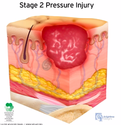 A Nurse's Visual Aid For Illustrating Pressure Injury Stages