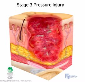 A Nurse's Visual Aid For Illustrating Pressure Injury Stages