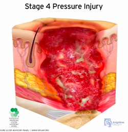 A Nurse's Visual Aid For Illustrating Pressure Injury Stages