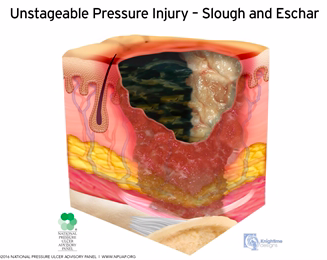 A Nurse's Visual Aid For Illustrating Pressure Injury Stages