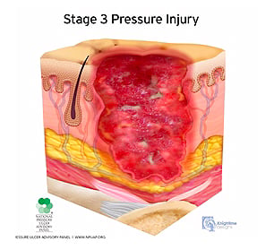 Airisana | Guide to Pressure Injury Prevention